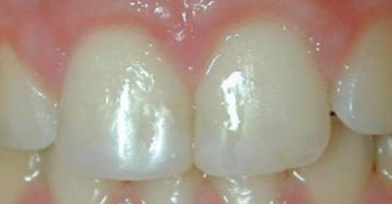 How To Get Rid From Puffy Gums