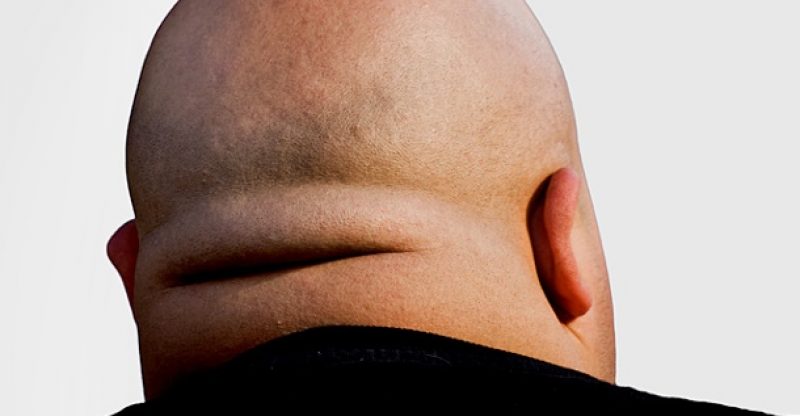 How To Get Rid of Neck Fat (Double Chin) – Exercises and Home Remedies